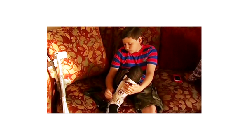 Boy, 11, wants his leg amputated | CNN