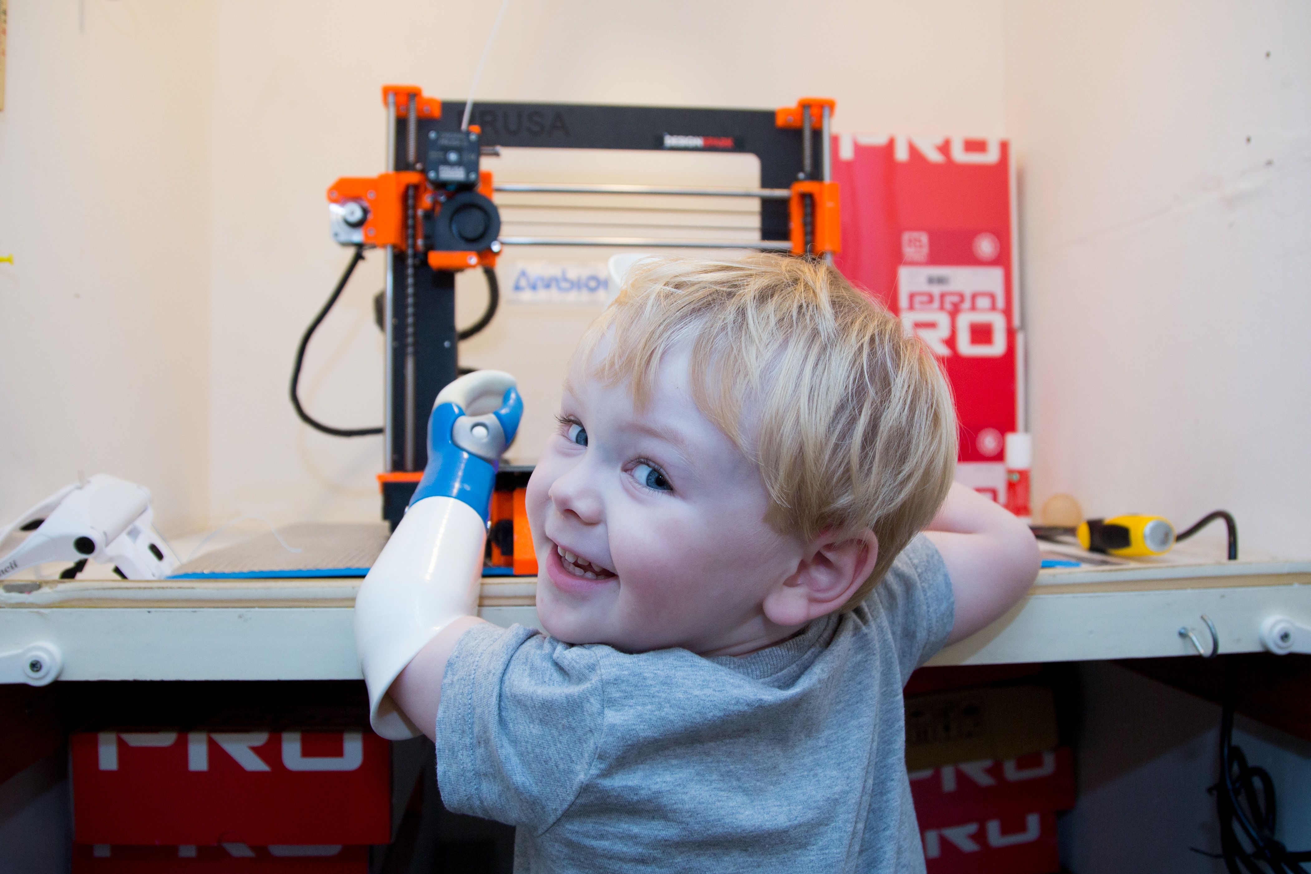 3d Printed Prosthetic Arm